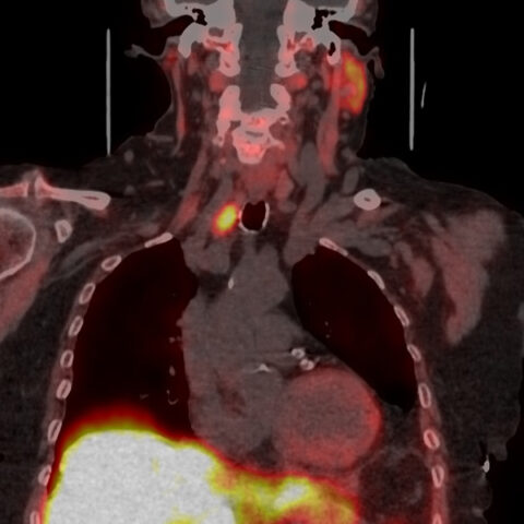 Tep Scan à la Fluoro-Choline | SCINTI 13