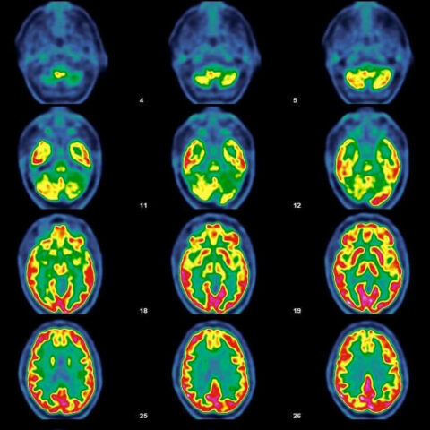 Examen Tep FDG au centre SCINTI 13