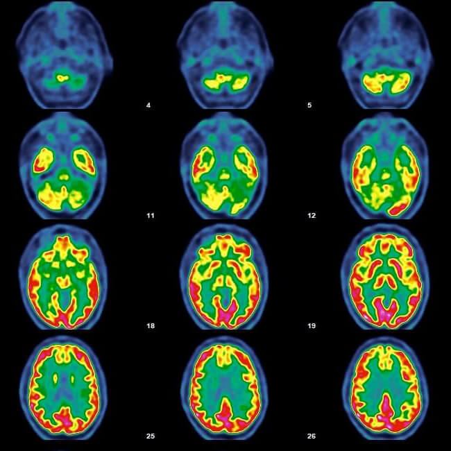 Examen Tep FDG au centre SCINTI 13